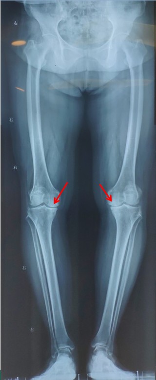 Common Types of Surgery for Total Knee Replacement (2) - Valgus Knee ...