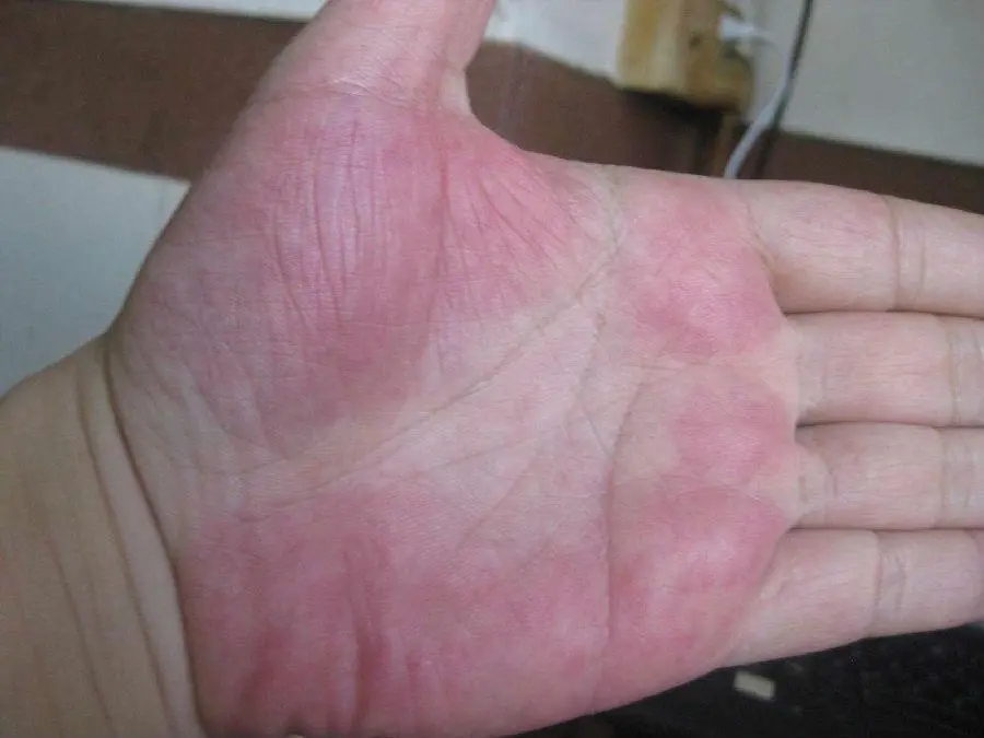 Why is liver cancer diagnosed at an advanced stage? - iNEWS