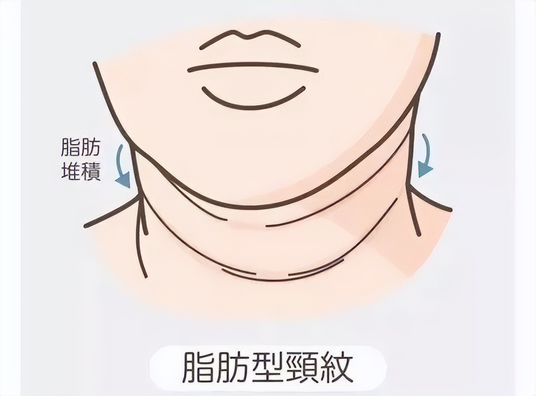 Neck lines that cannot be ignored - iNEWS