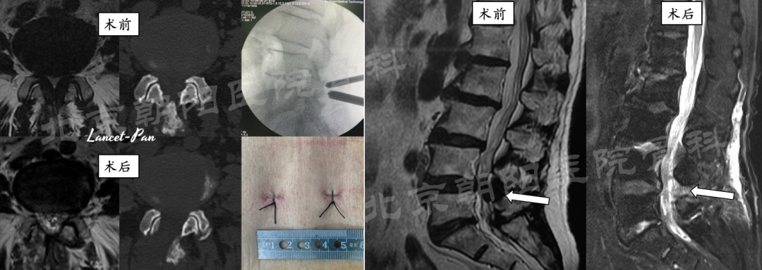 20 cases of UBE surgery learning curve - iNEWS