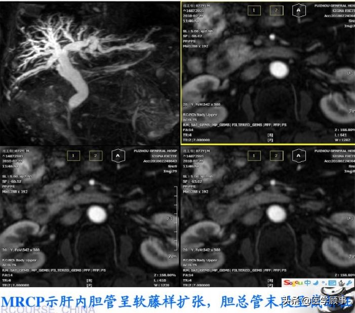 Imaging manifestations and differential diagnosis of ampullary ...