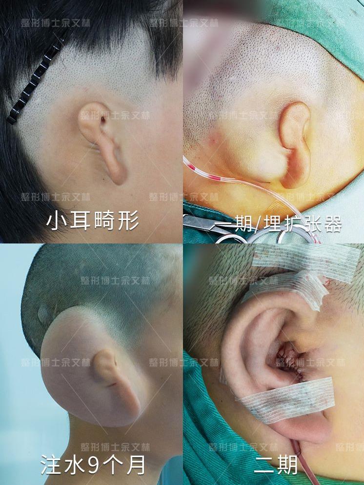 Why is the timing of ear reconstruction surgery important for patients ...