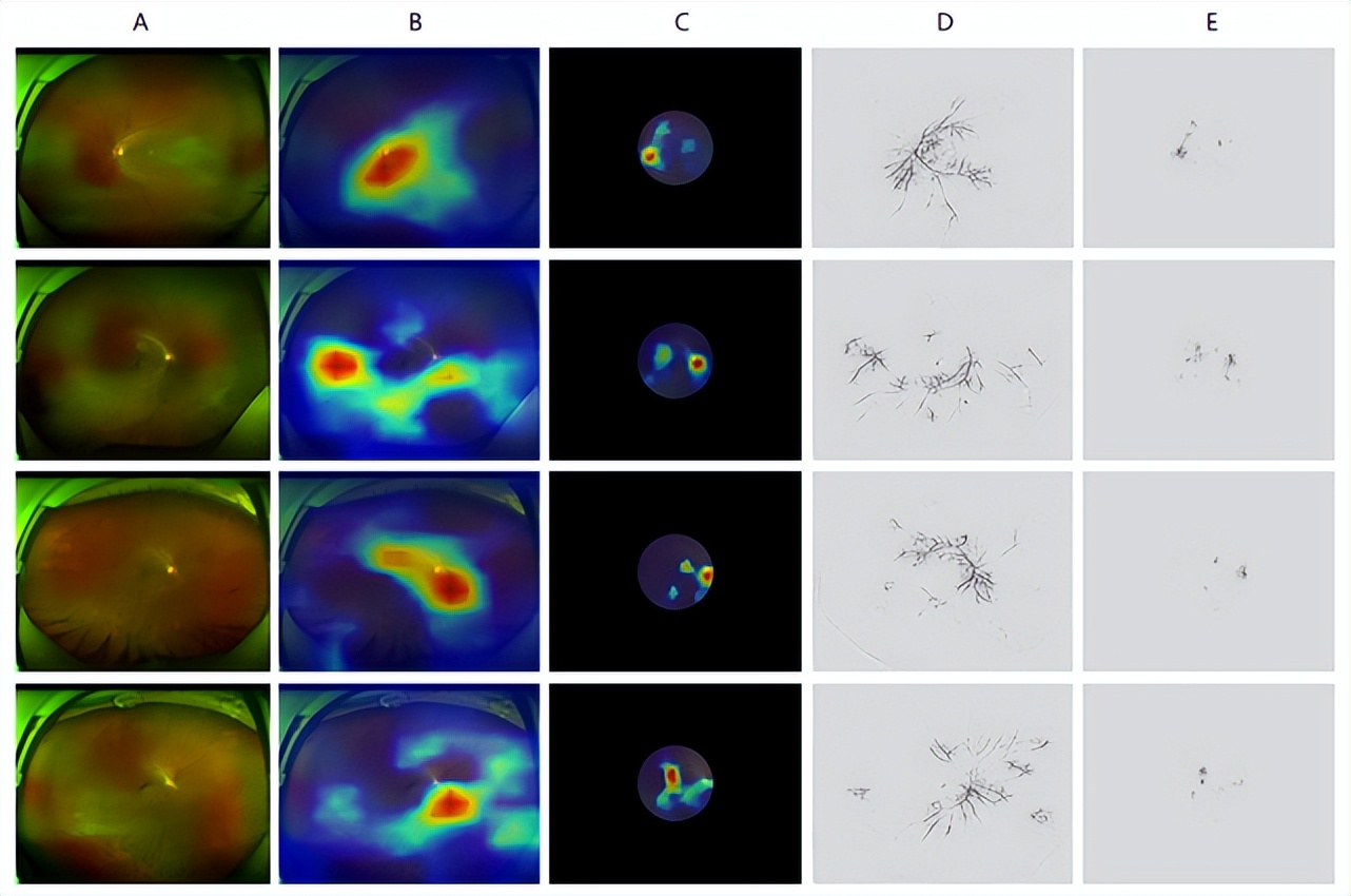 Prediction of hemoglobin concentration and screening of anemia by ultra-wide-angle fundus ...