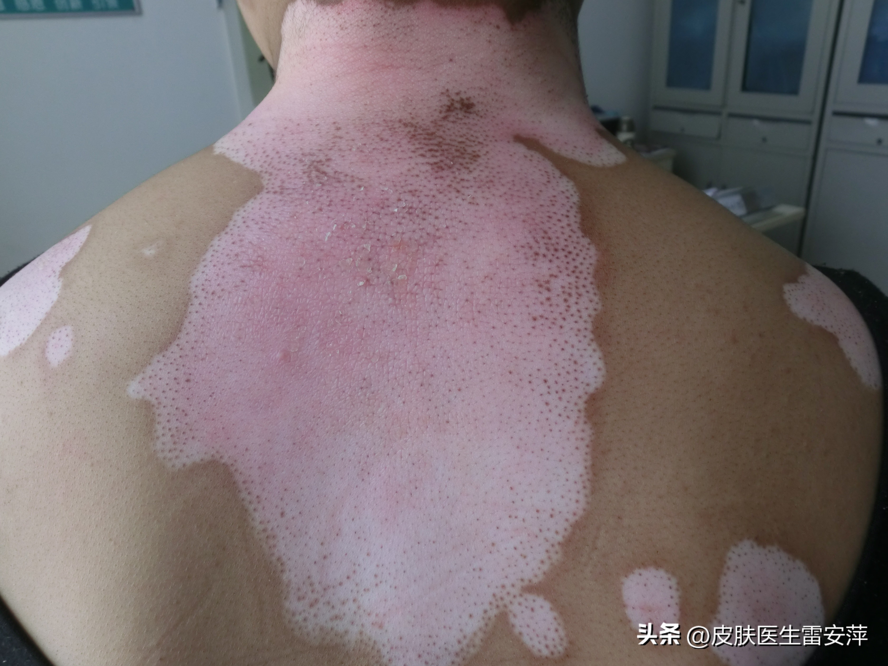 Is your vitiligo segmental or common? - iNEWS