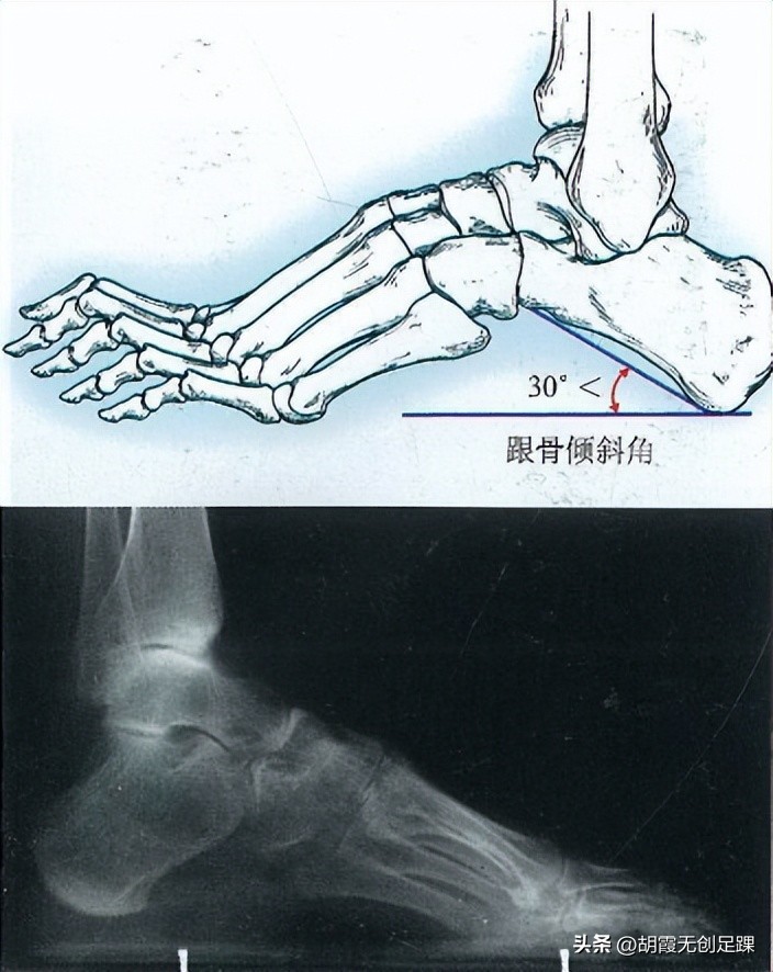 The four types of high arched feet, don't wait until they are serious ...