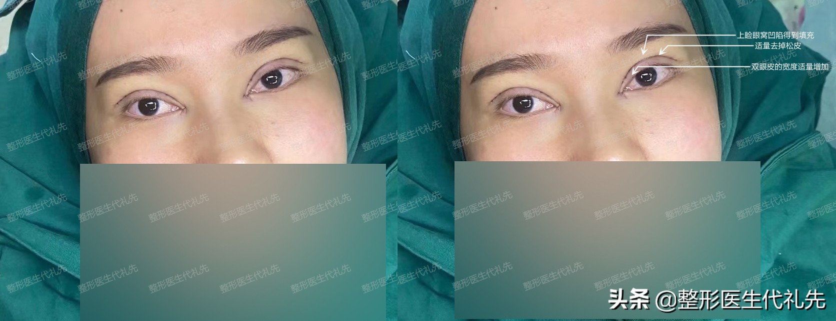 Sunken eye sockets and narrowed double eyelids, the doctor will take ...