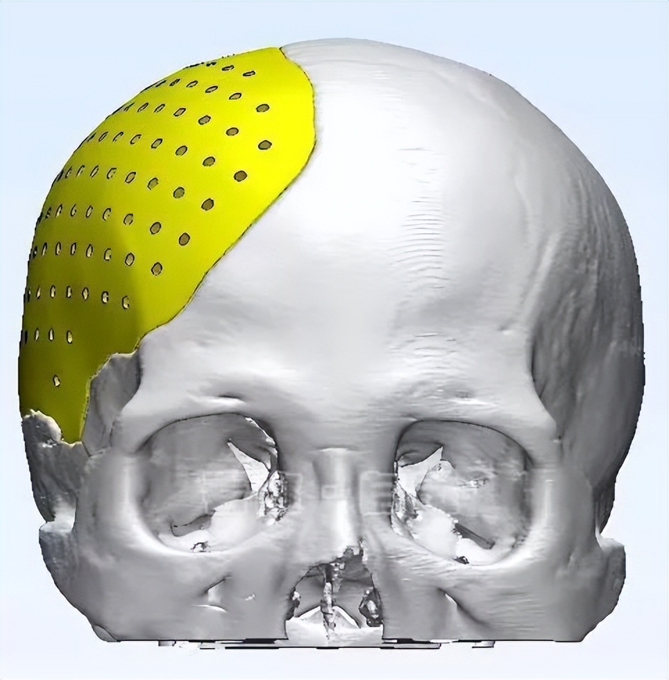 Application of PEEK 3D in skull defects (2) - iNEWS