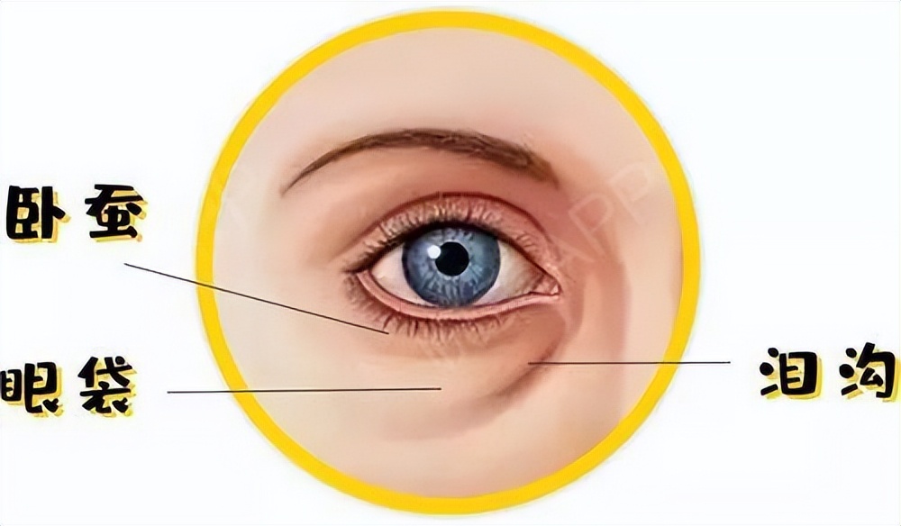 How to remove the most reliable tear trough - iMedia