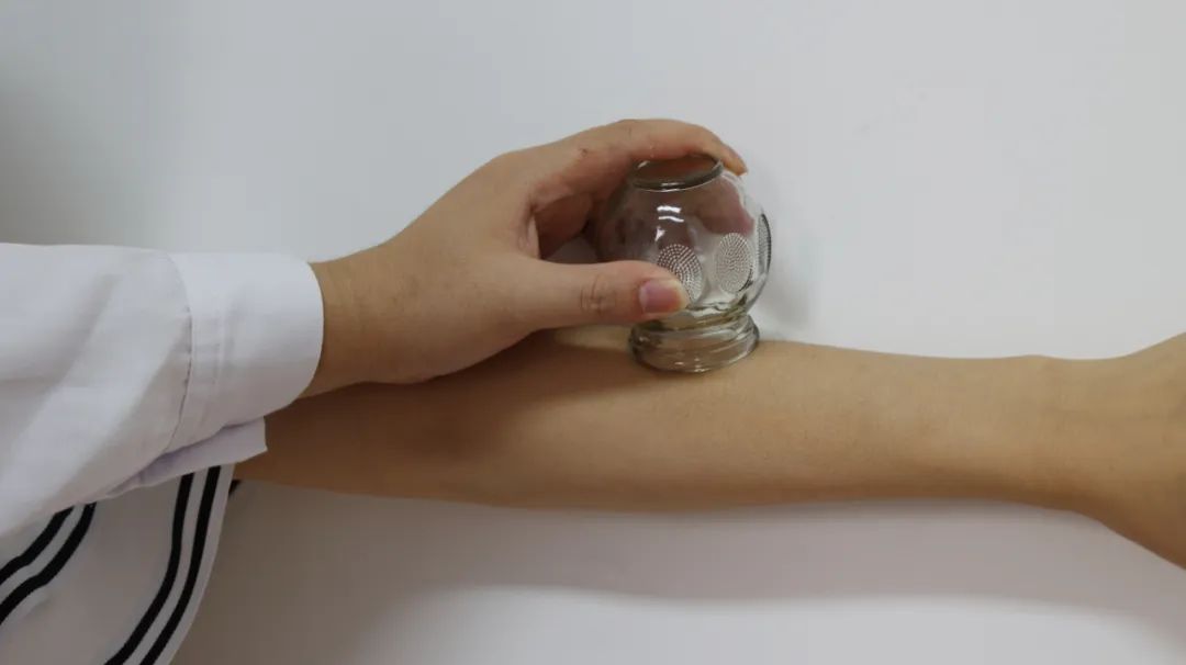 The imprints left after cupping have nothing to do with toxins, but ...