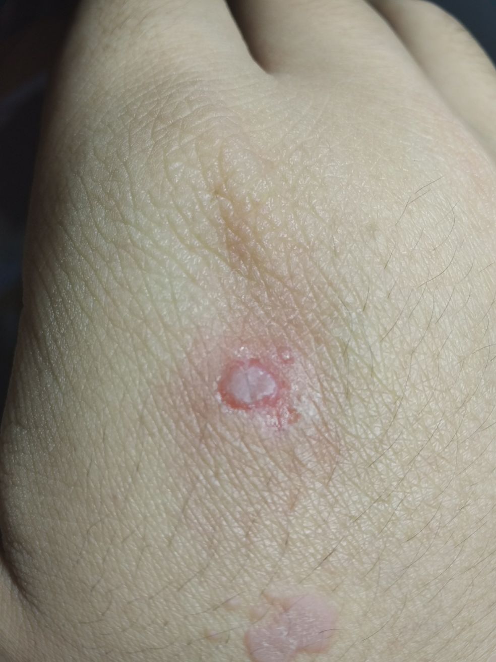 What is the reason for the "small meat grains" on the neck? Do I need ...