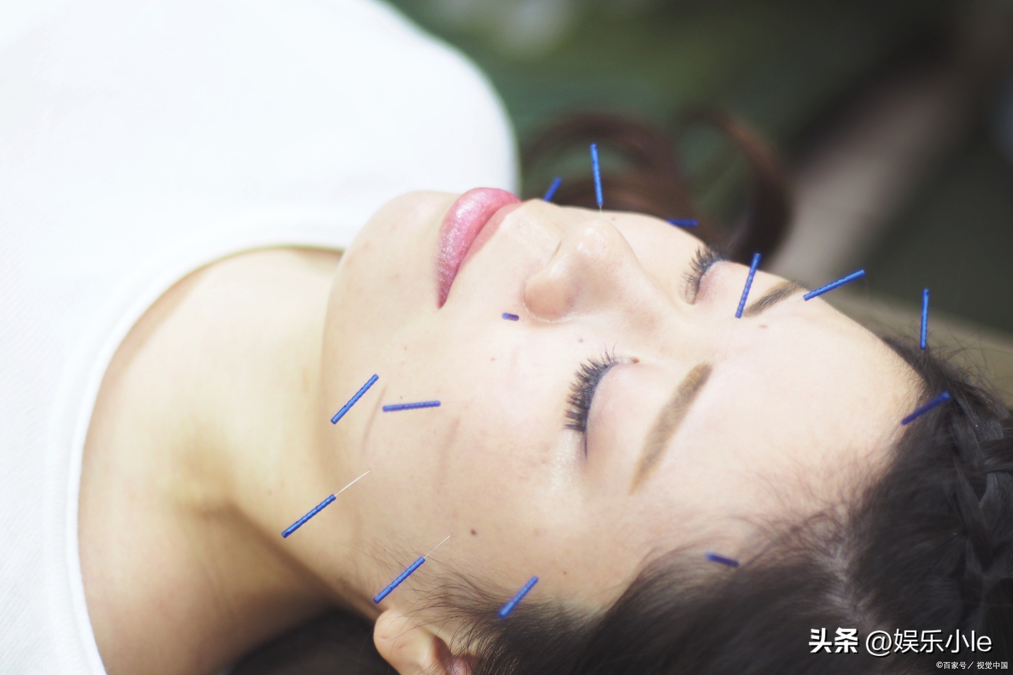 Where did beauty needles come from? Why do problems continue, and how ...