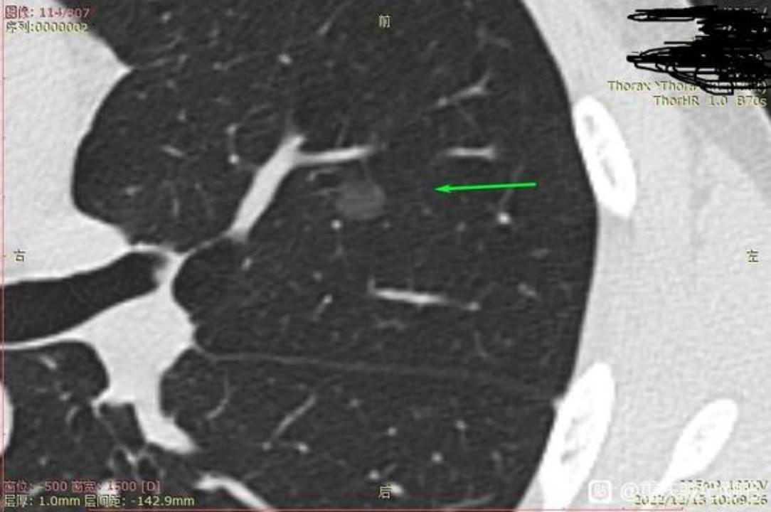 26-year-old met with 8mm pulmonary nodule with blood vessel perforation ...