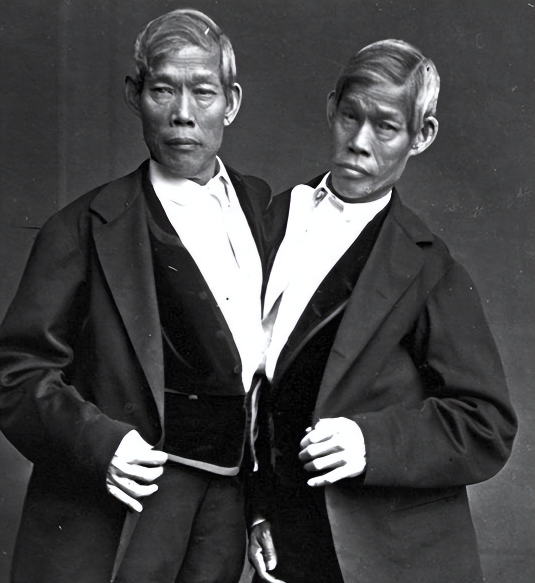Conjoined twins have 22 children? Brothers separated by surgery ...