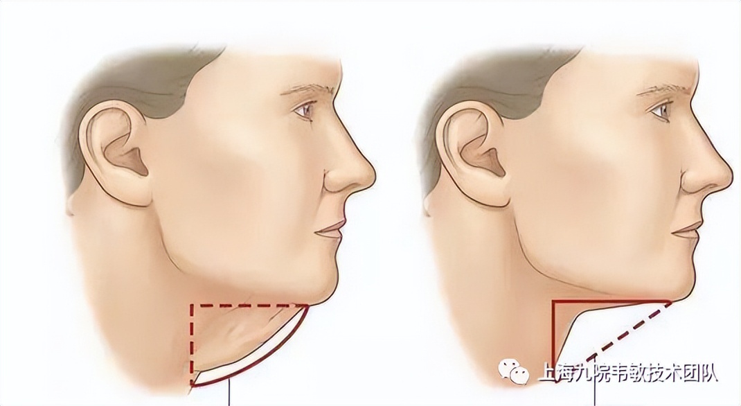 Why is there no clear dividing line between the chin and the neck? - iNEWS