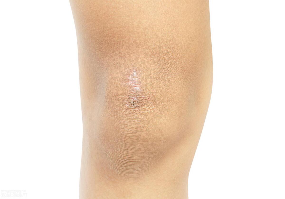 The wound left a scar, but the scar suddenly turned red and raised ...