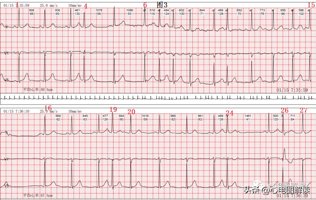 The "harm" of atrial premature beats: atrial premature beats, atrial ...
