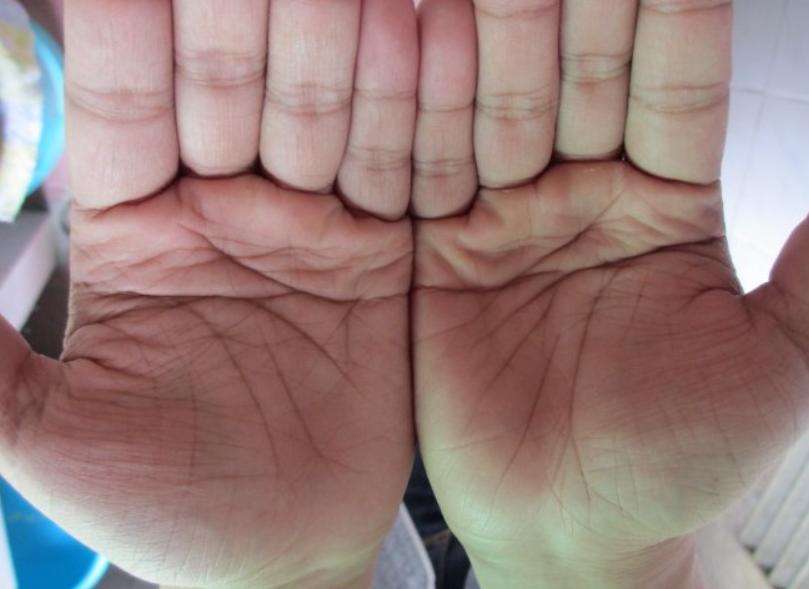 As the saying goes: "A broken palm is a line, wealth and honor are not ...