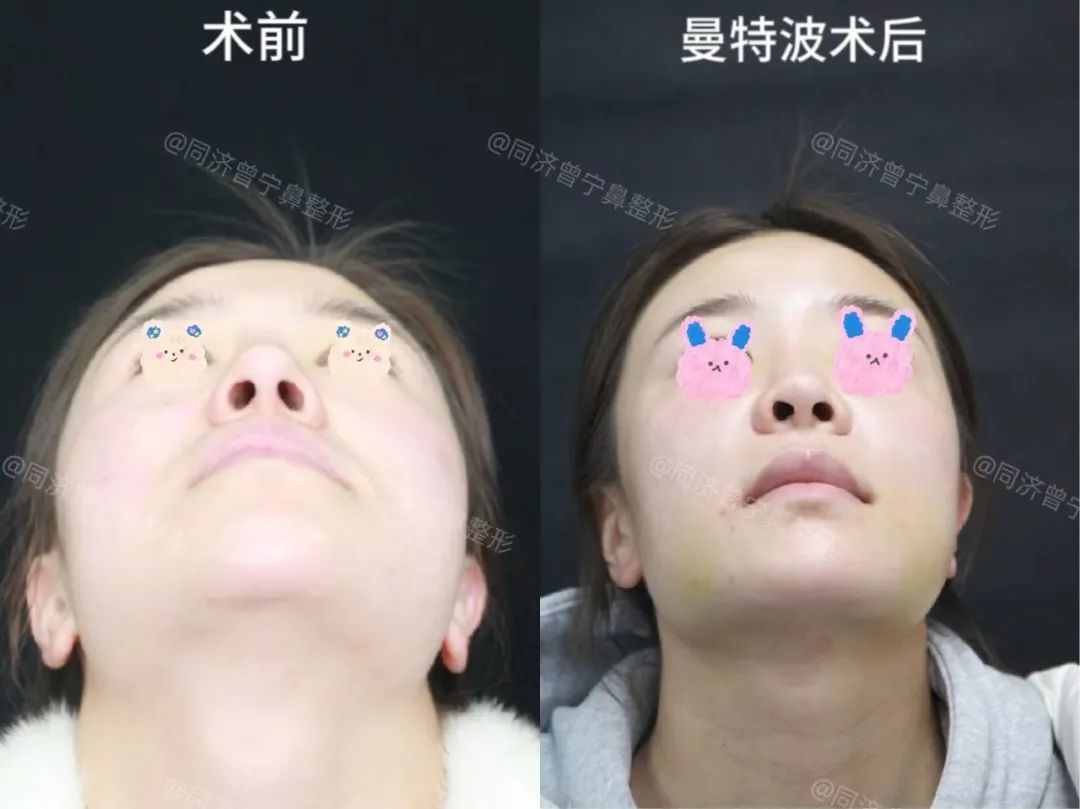 How to save a sunken nasal base? - iNEWS