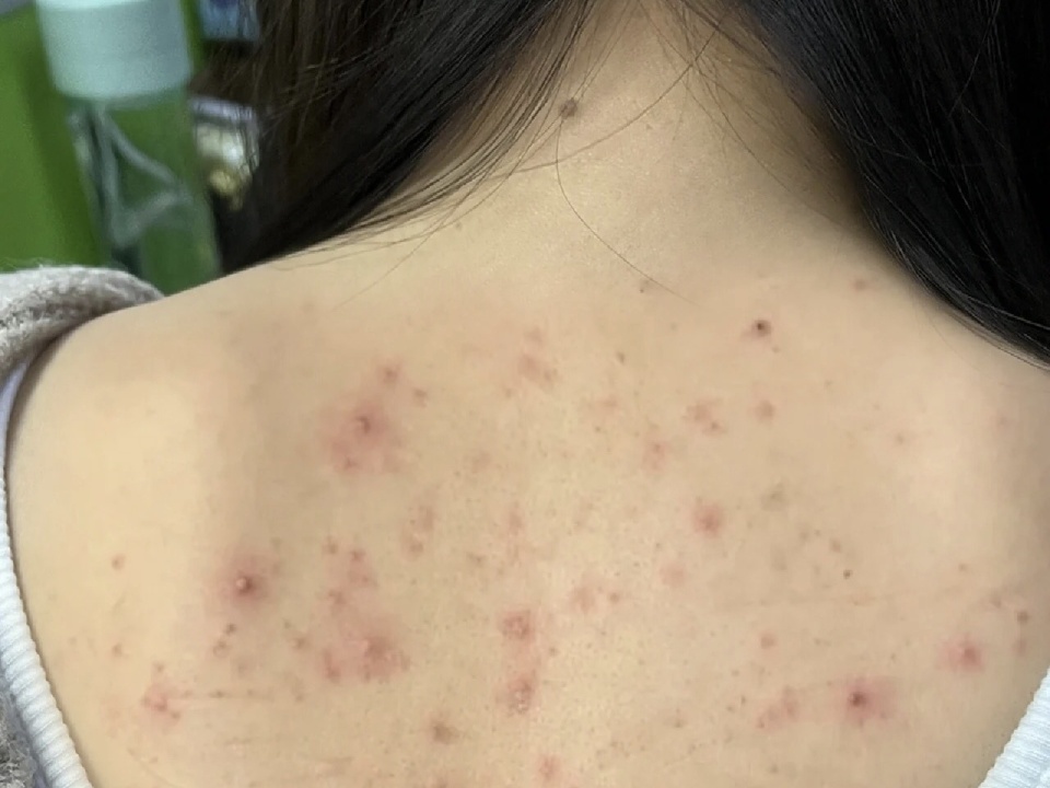 Get rid of back acne with just these simple steps! You can have a ...