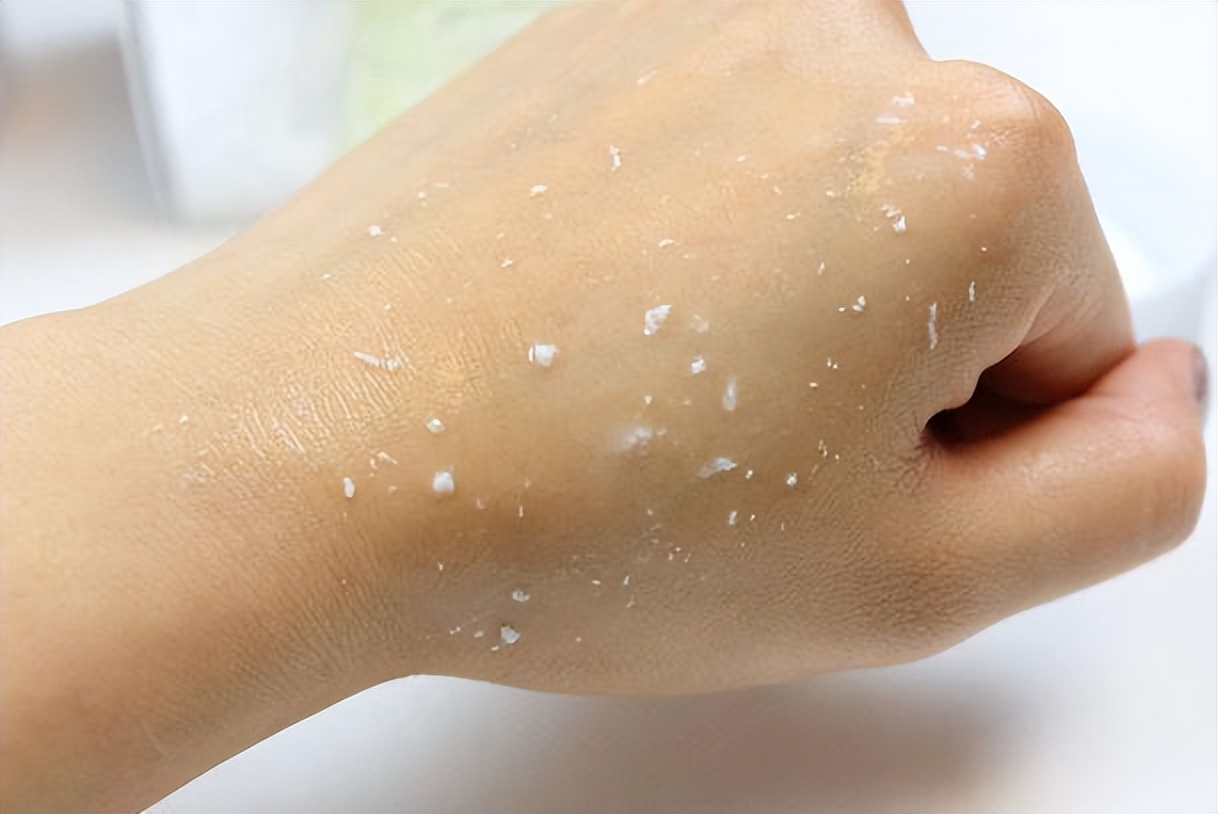 Summer: Why do some people "tan as soon as they get sunburned" and some ...