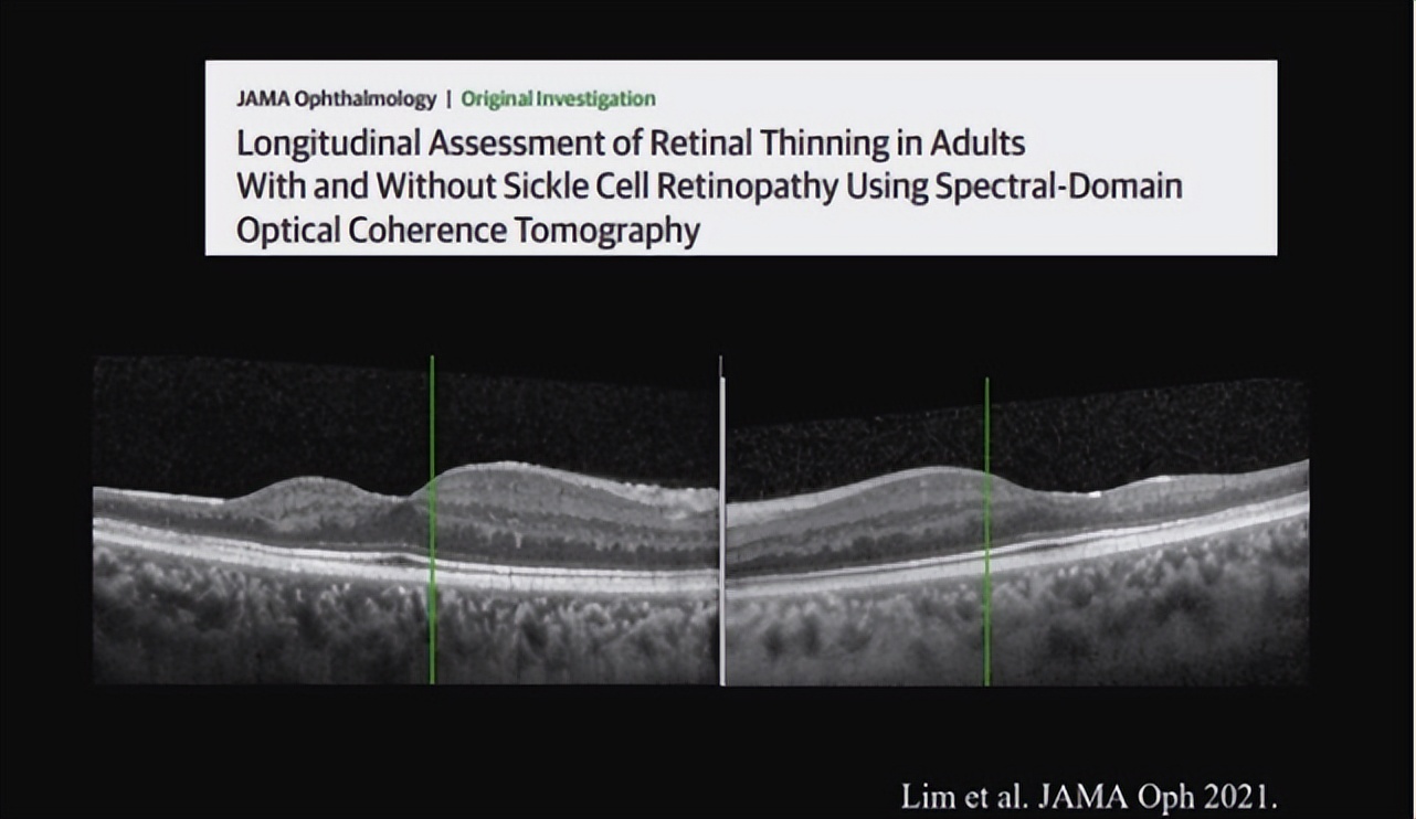 Sickle cell retinopathy: progress and breakthroughs - iNEWS