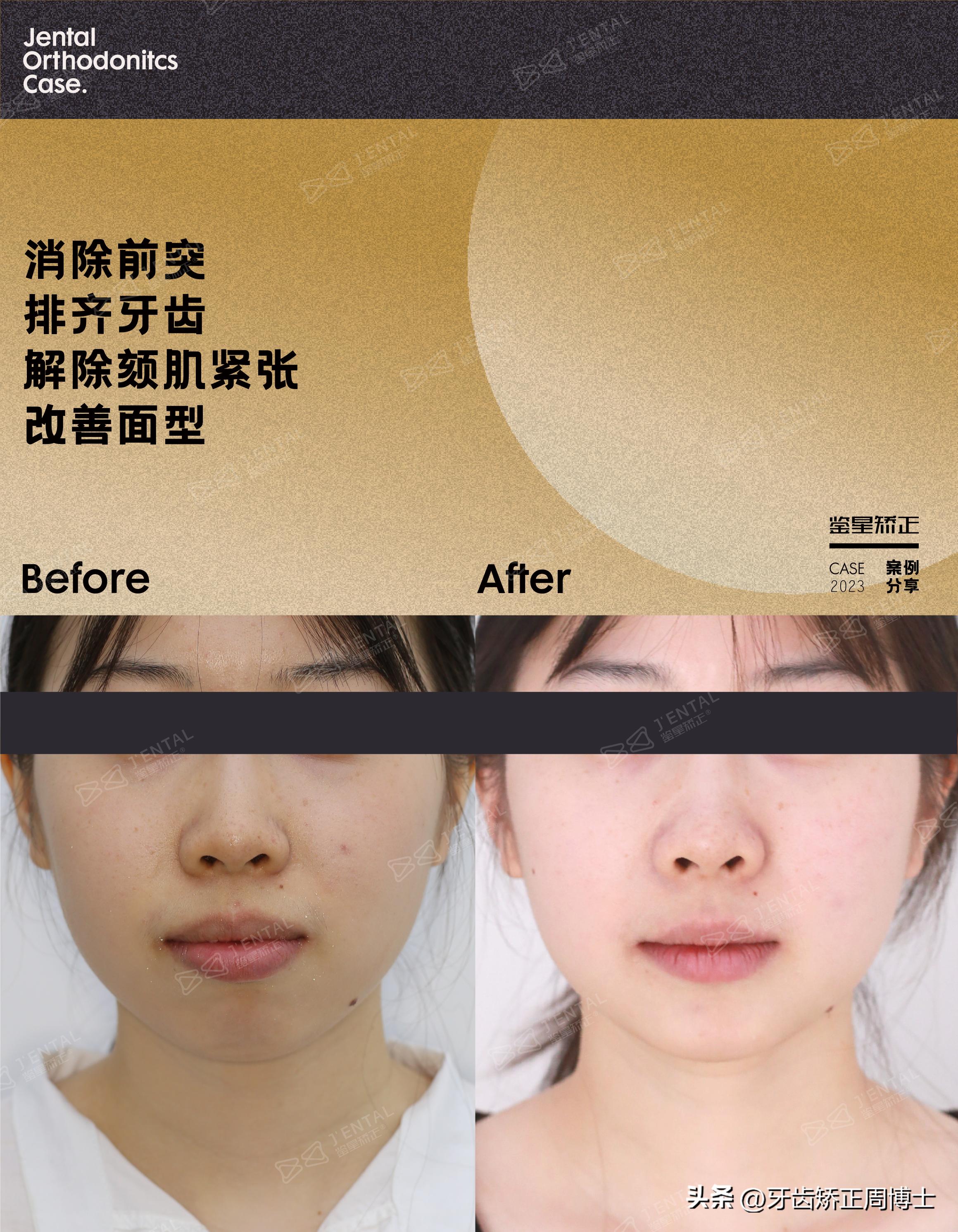 8 bone nails with upper and lower jaw reverse rotation, poor mandible ...