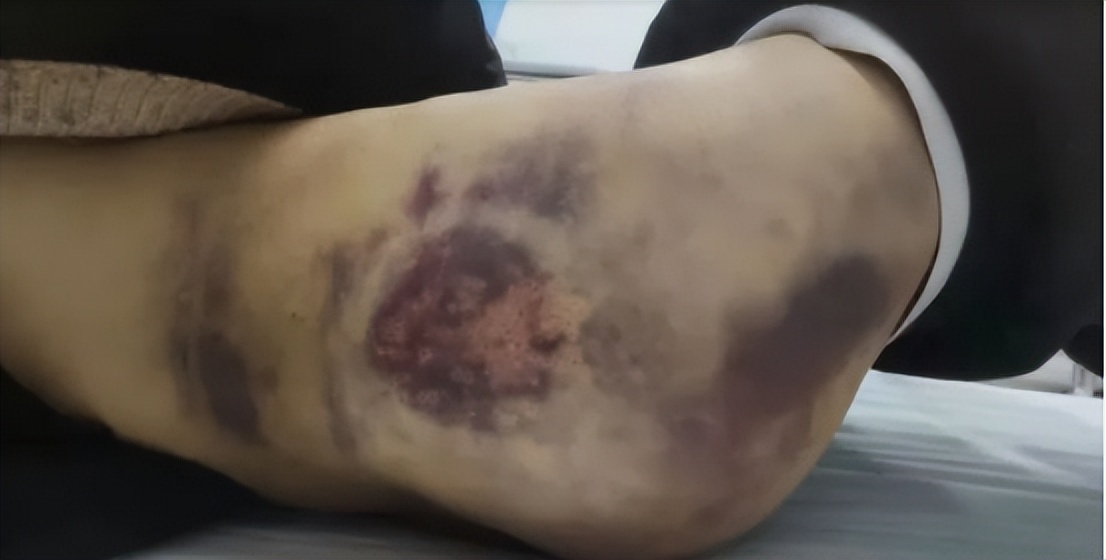Popular science on the dangers of long-term use of fascia guns: Four ...