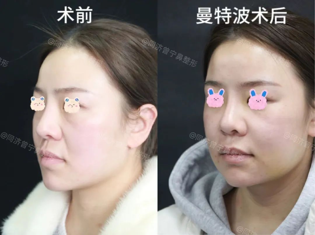 How to save a sunken nasal base? - iNEWS