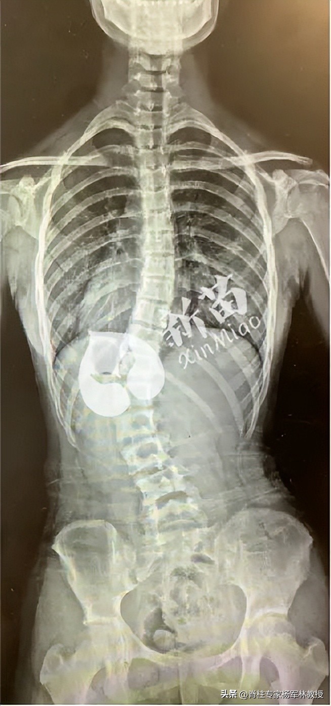 The "real culprit" behind the high and low shoulders may be scoliosis ...