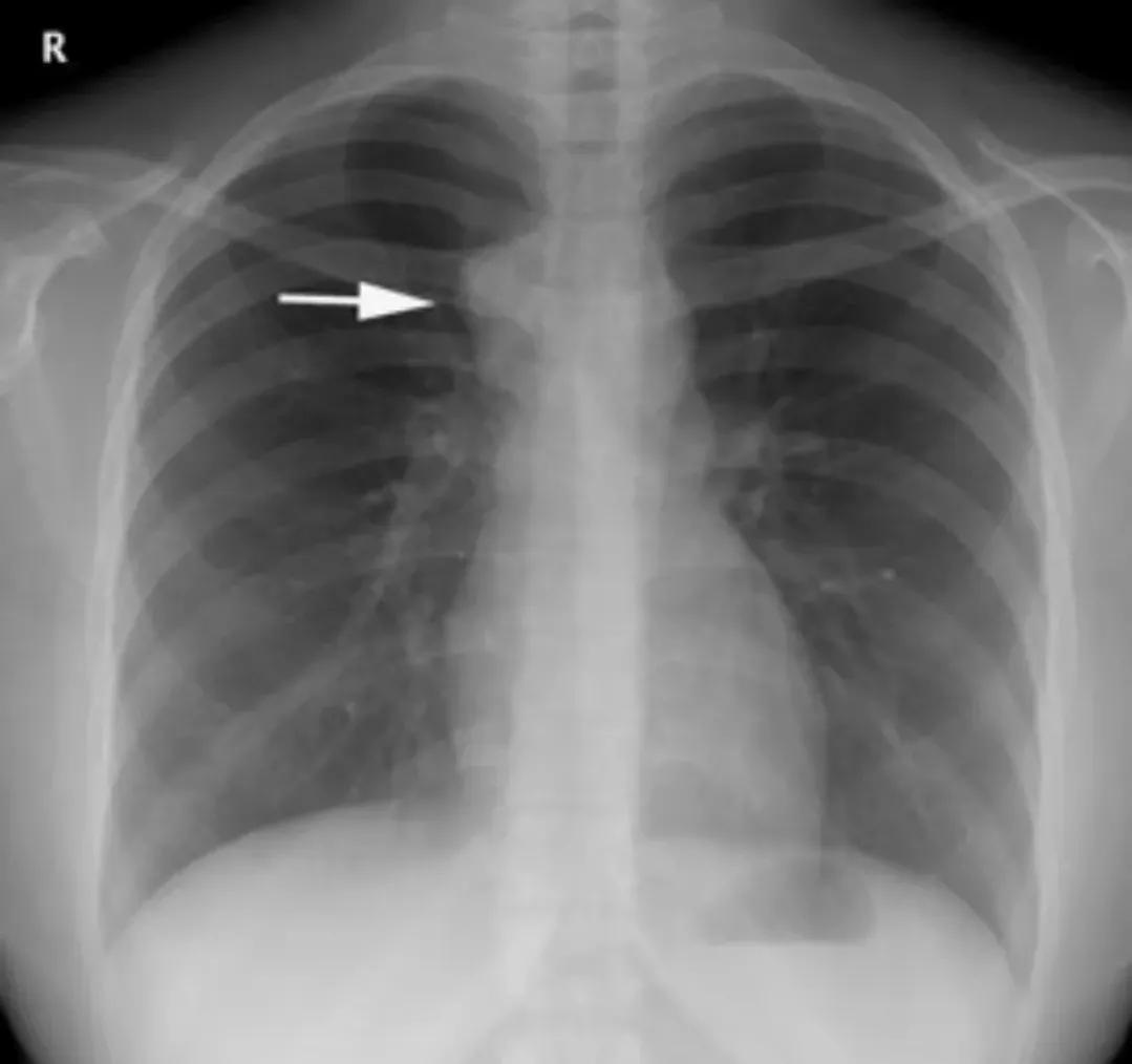 The classification and imaging manifestations of pulmonary tuberculosis ...