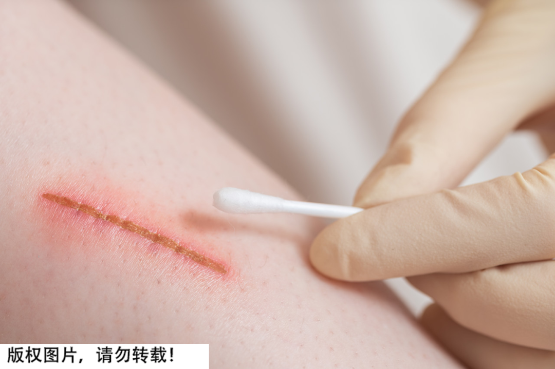 Why is the scab so itchy?The more you pull the top?hurry up... - iNEWS