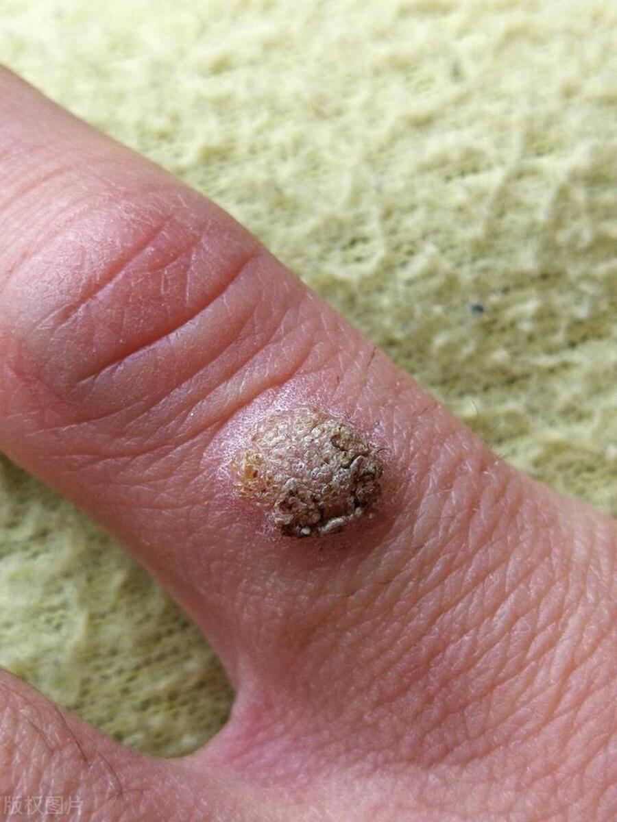 Four major symptoms of HPV infection, women's health should not be ...