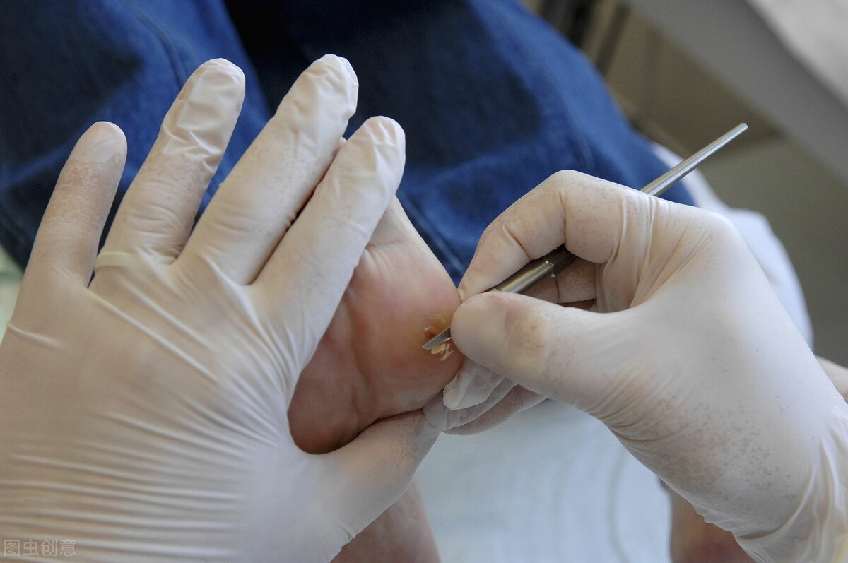 Diabetic feet are called "old and rotten feet." What will happen if the ...