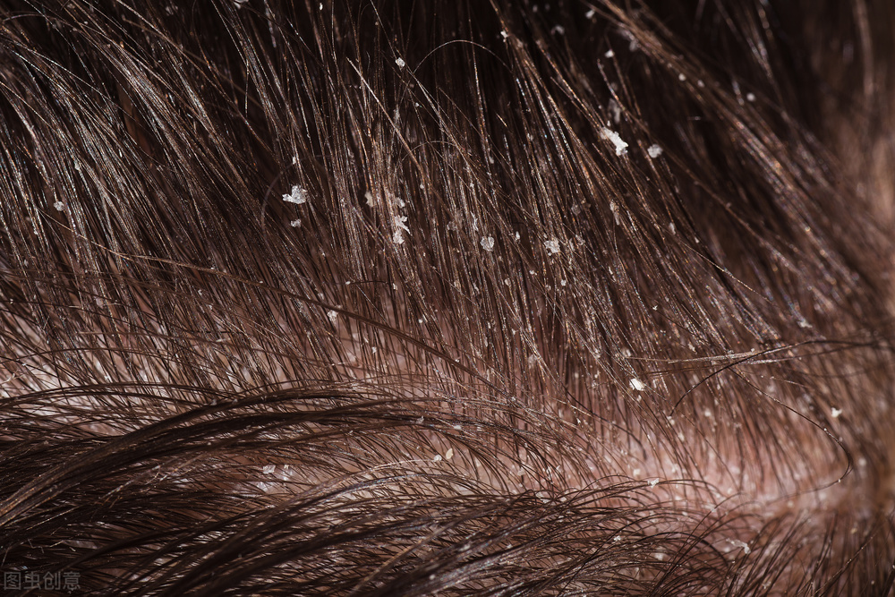 The dandruff is like snowflakes and the scalp is very greasy, don't ...