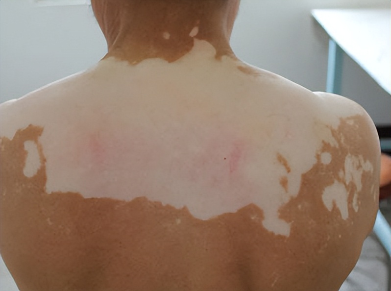 Why can't folk remedies be trusted in the treatment of vitiligo? - iNEWS
