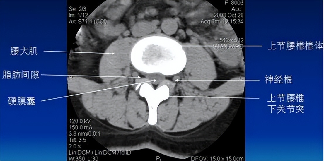 Lumbar spine CT anatomy, bulge, protrusion and degeneration diagnostic ...