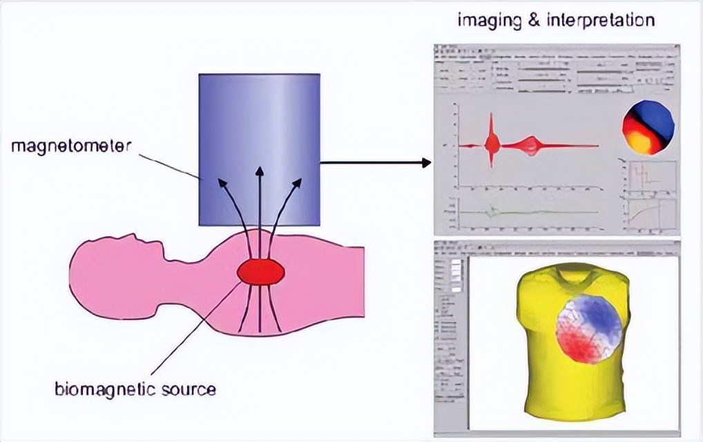 Magnetocardiogram - the new star of cardiovascular examination coming ...