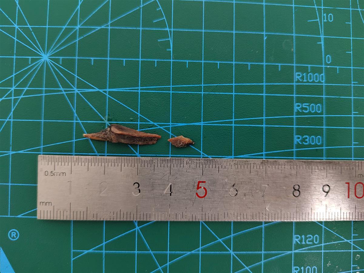 The man coughed and coughed up phlegm repeatedly for 20 years, but the ...