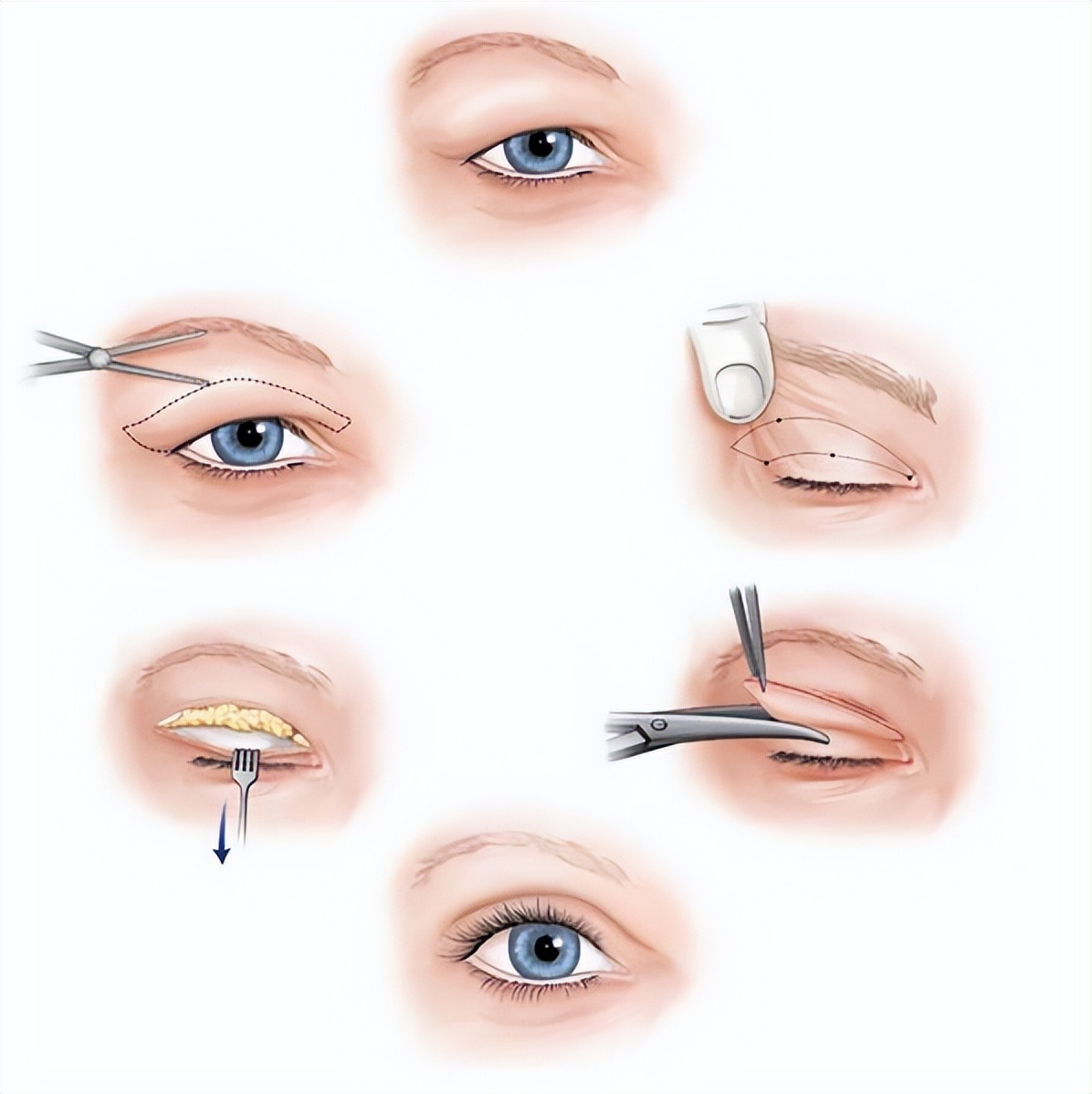 7 out of 10 people who have double eyelid surgery regret it. It is very ...