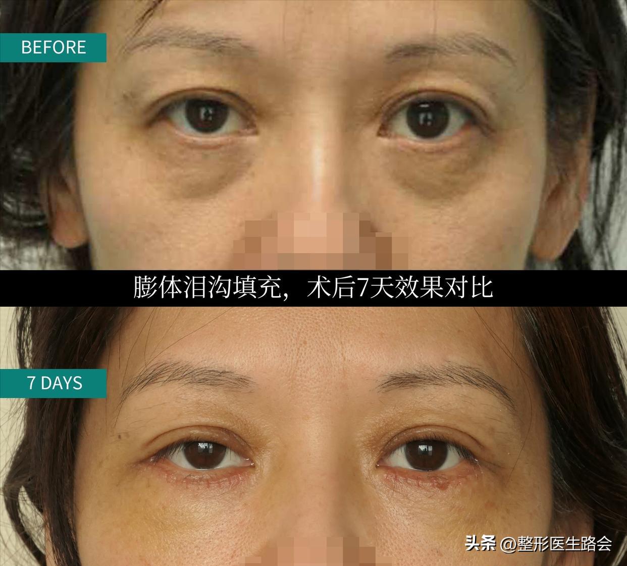 40-50 years old have deep tear grooves, what should I do? The doctor ...