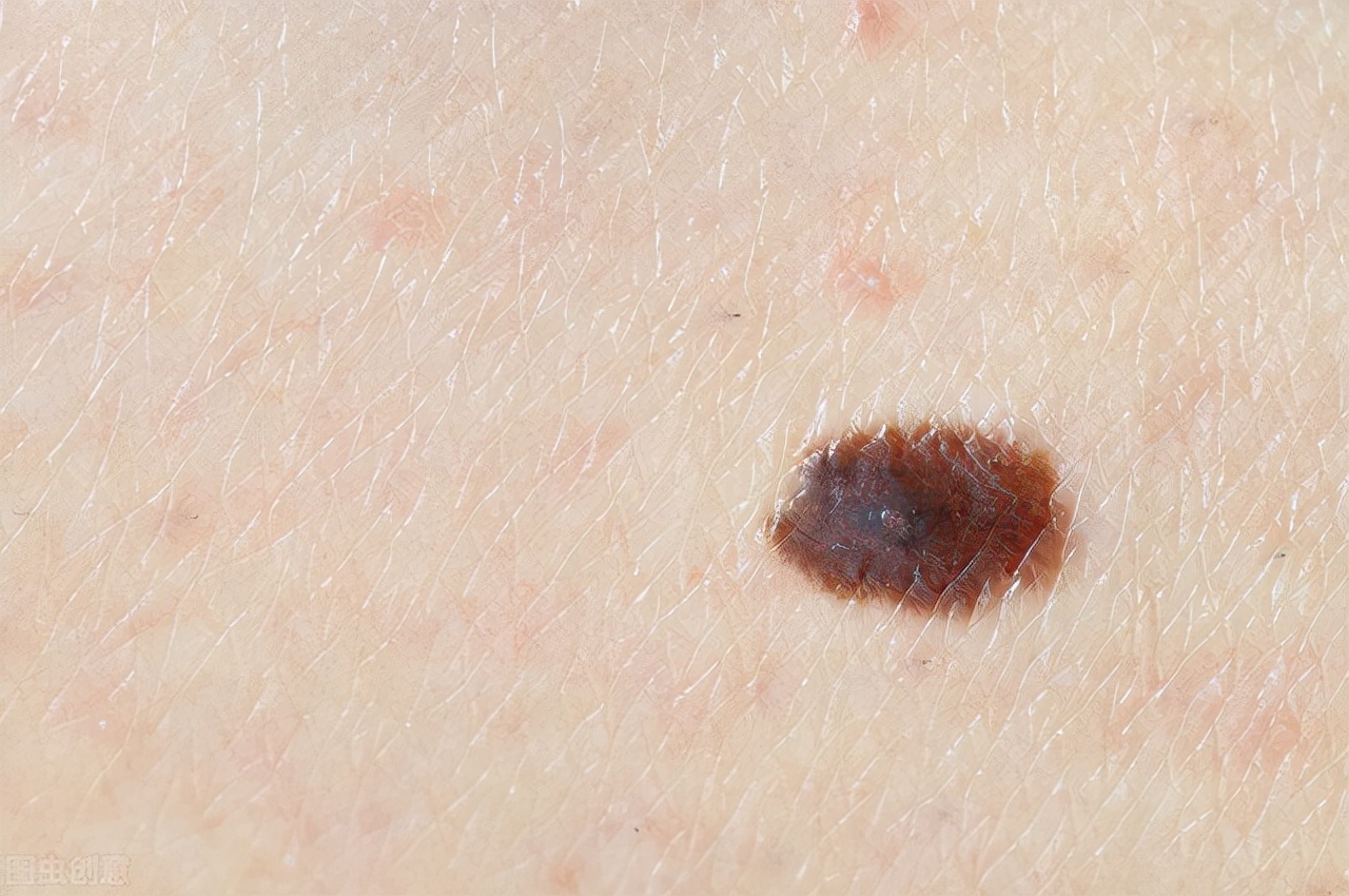 Everyone has a "mole" to talk about the color change?Don't panic, the ...