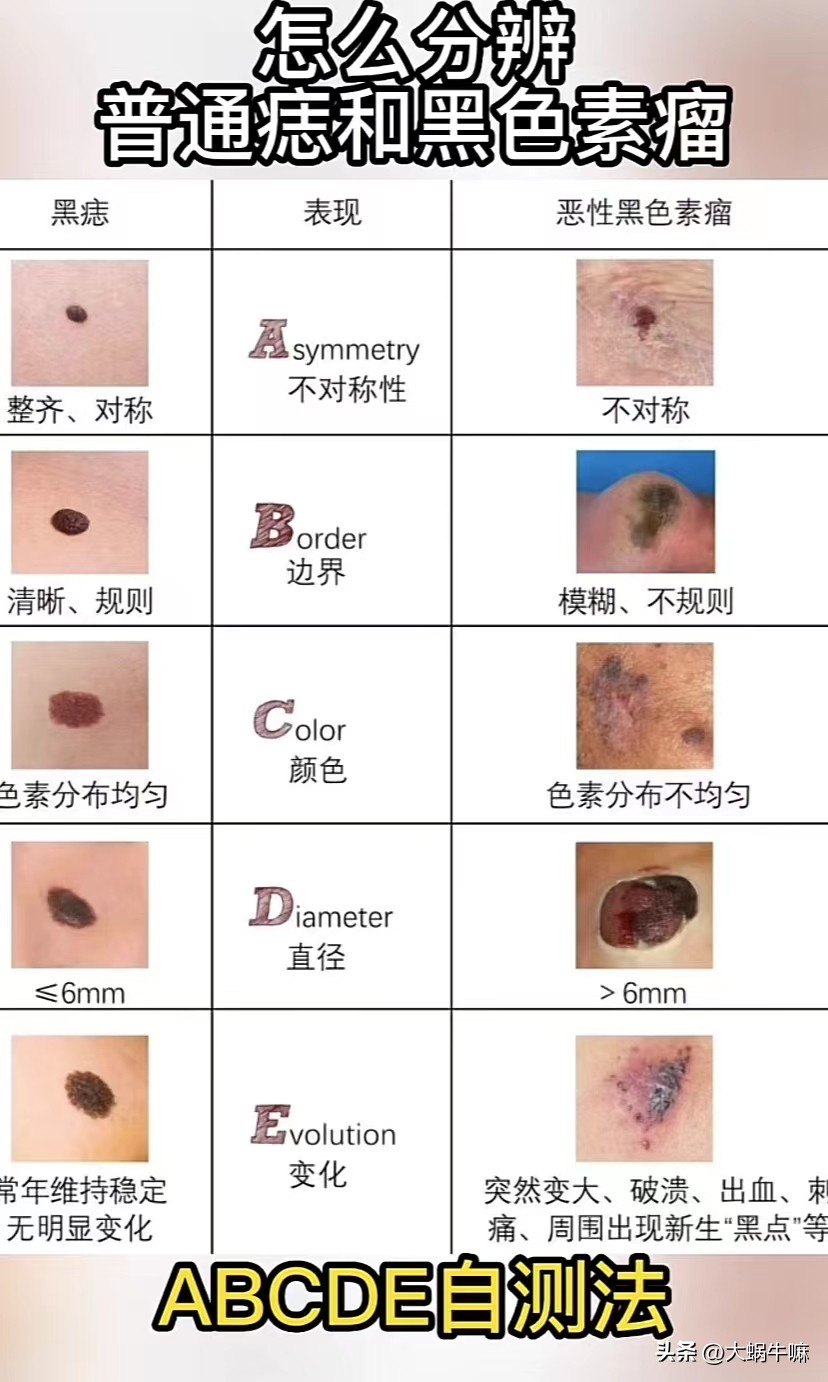 How to tell the difference between a normal mole and a melanoma? - iNEWS