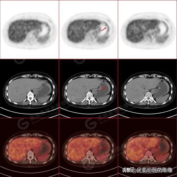 18F-FDG PET/CT manifestations and clinical value of gastric MALT ...