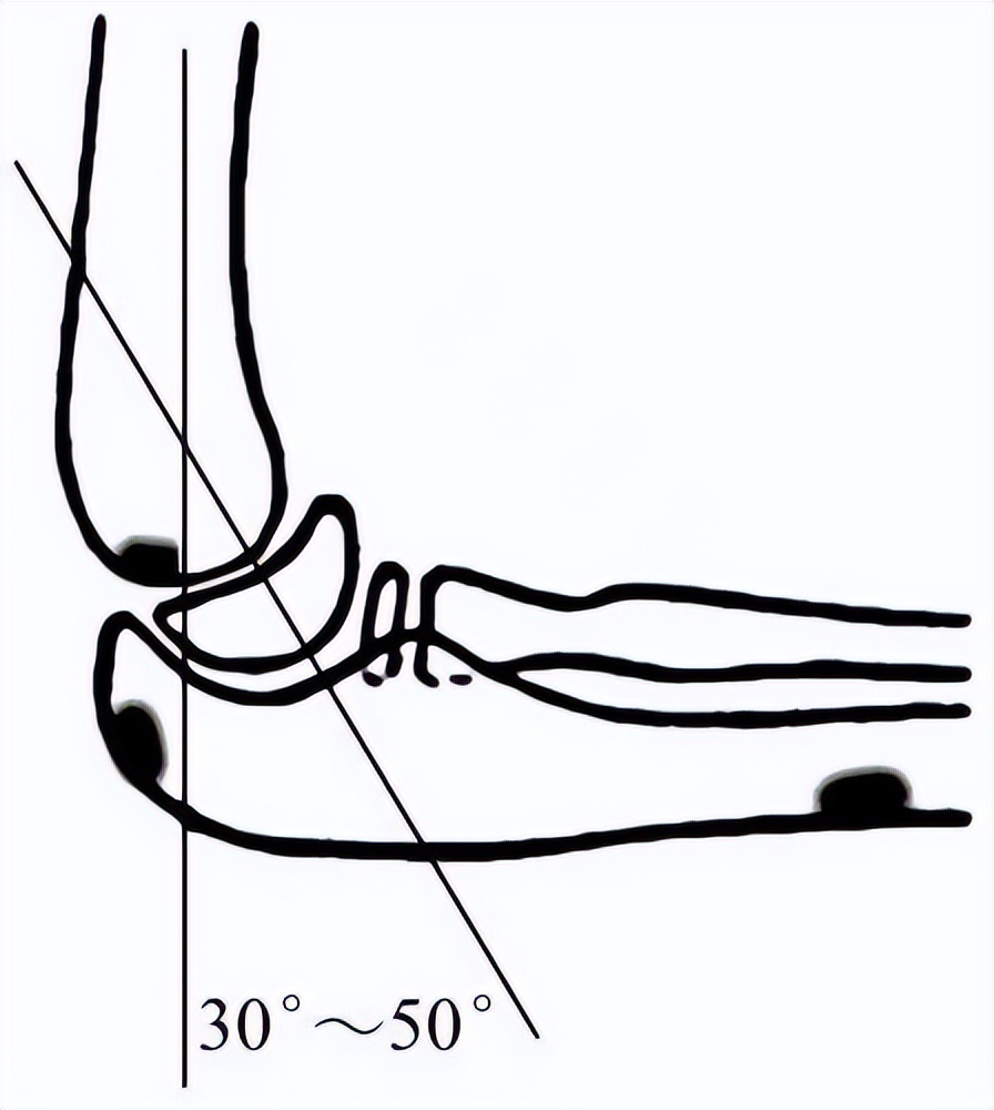 Points for attention in the diagnosis and treatment of elbow fractures ...