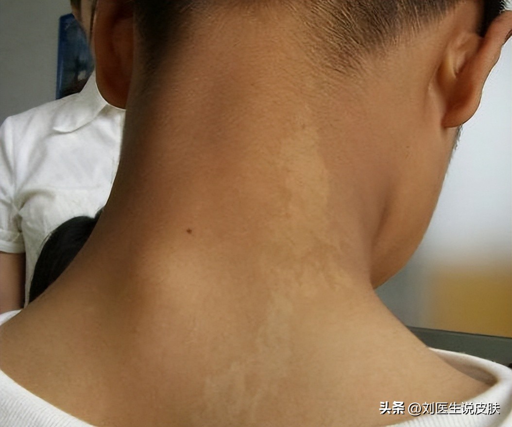 White spots on the skin in summer are not all vitiligo, but these 3 ...