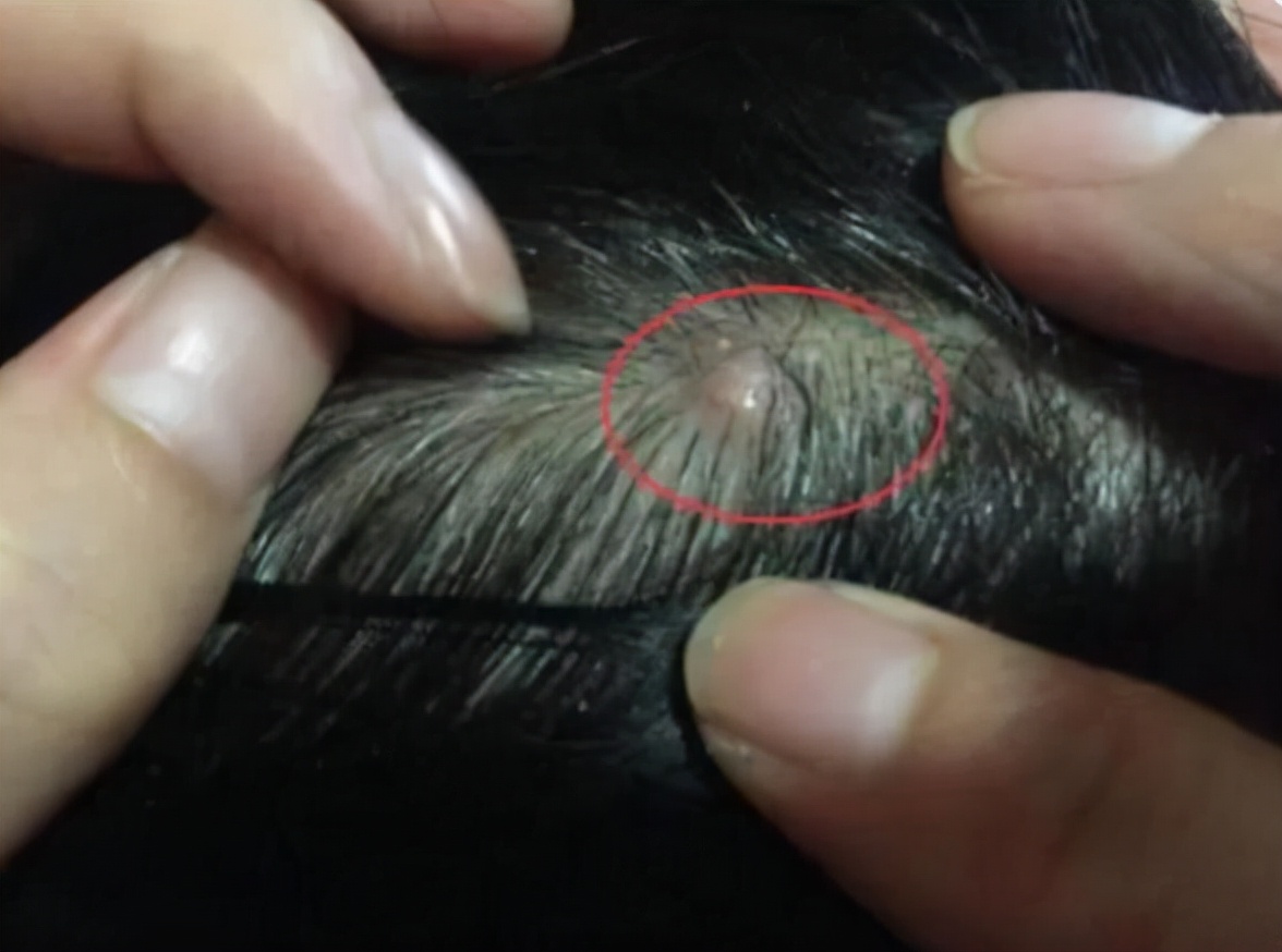 Why does the scalp always grow "pustules" and "pimples"?Maybe 4 reasons ...