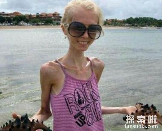 The thinnest person in the world: Kseniya Bubenko, excessive weight ...