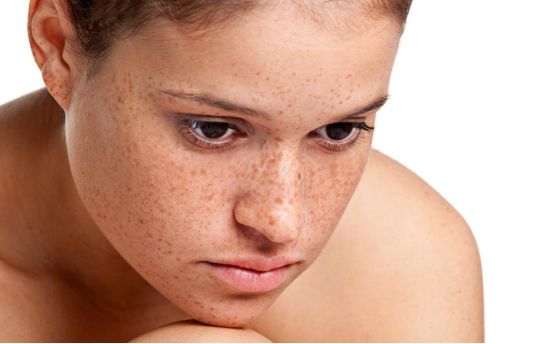 The correct way to remove freckles in summer! How much did you get ...