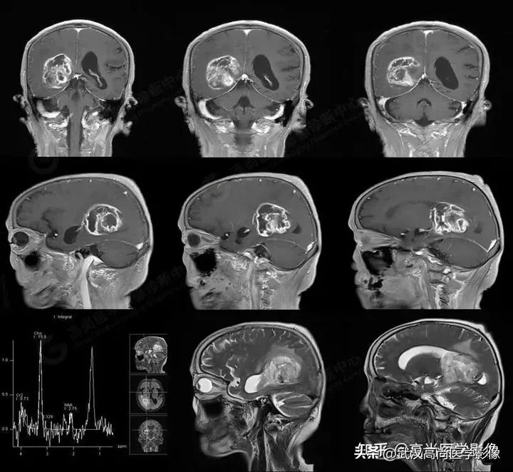 The "bomb" growing in the brain is very harmful, and the risk of ...
