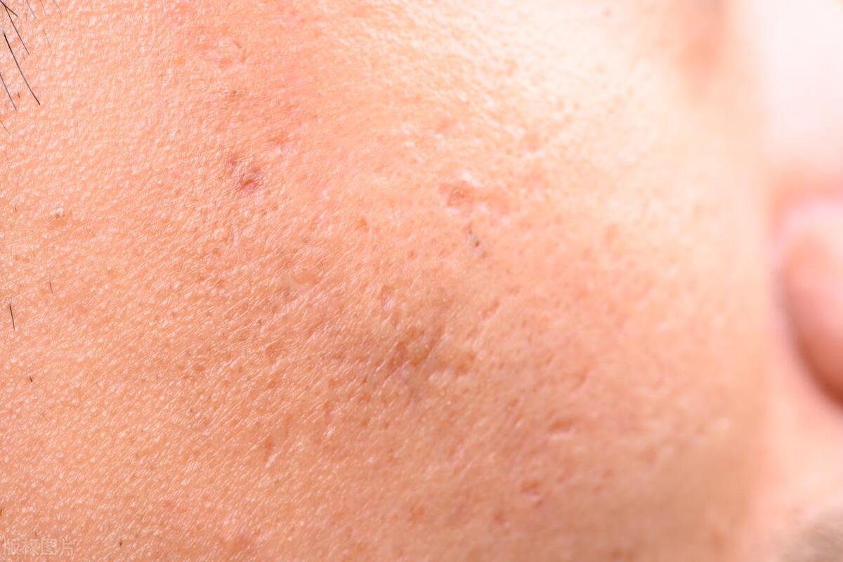 If you don't deal with acne marks, will you be fine? Metabolism and ...